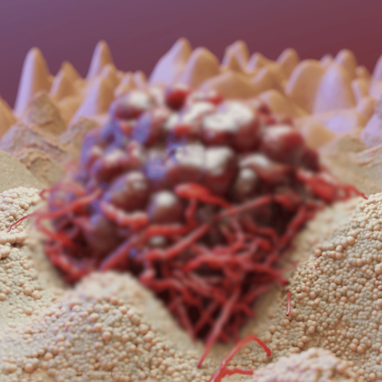 Nowoczesne leczenie raka prostaty | URO BLOG